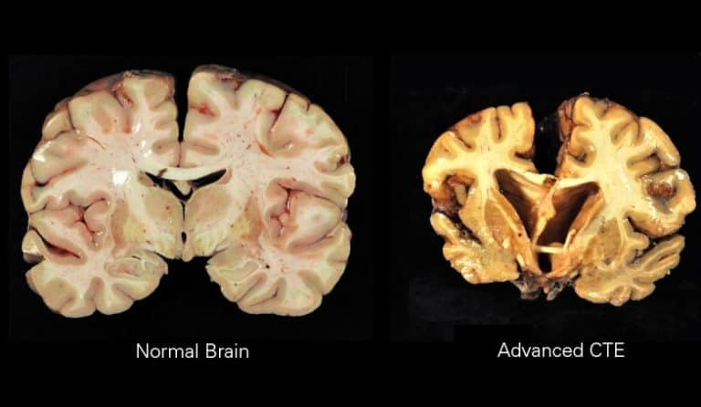 Do MMA Fighters Get Brain Damage? – MMA Channel
